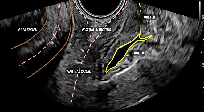 Ultrasound Assessment of Pelvic Anatomy | Article | GLOWM